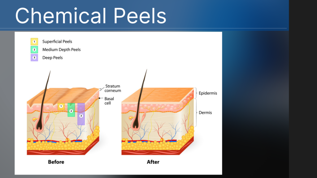 Chemical Peels