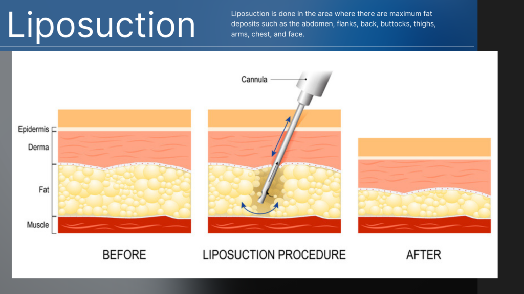 Liposuction